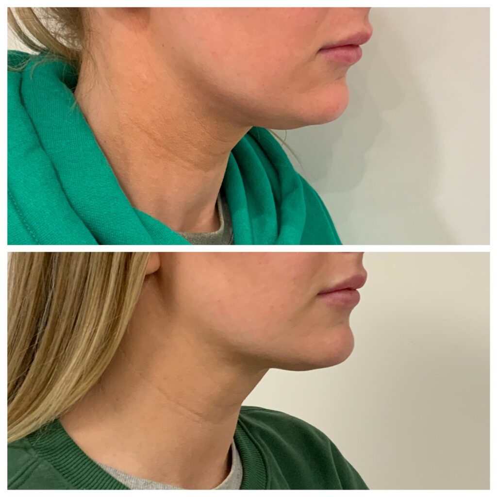 Kybella - Skinlab Injectables