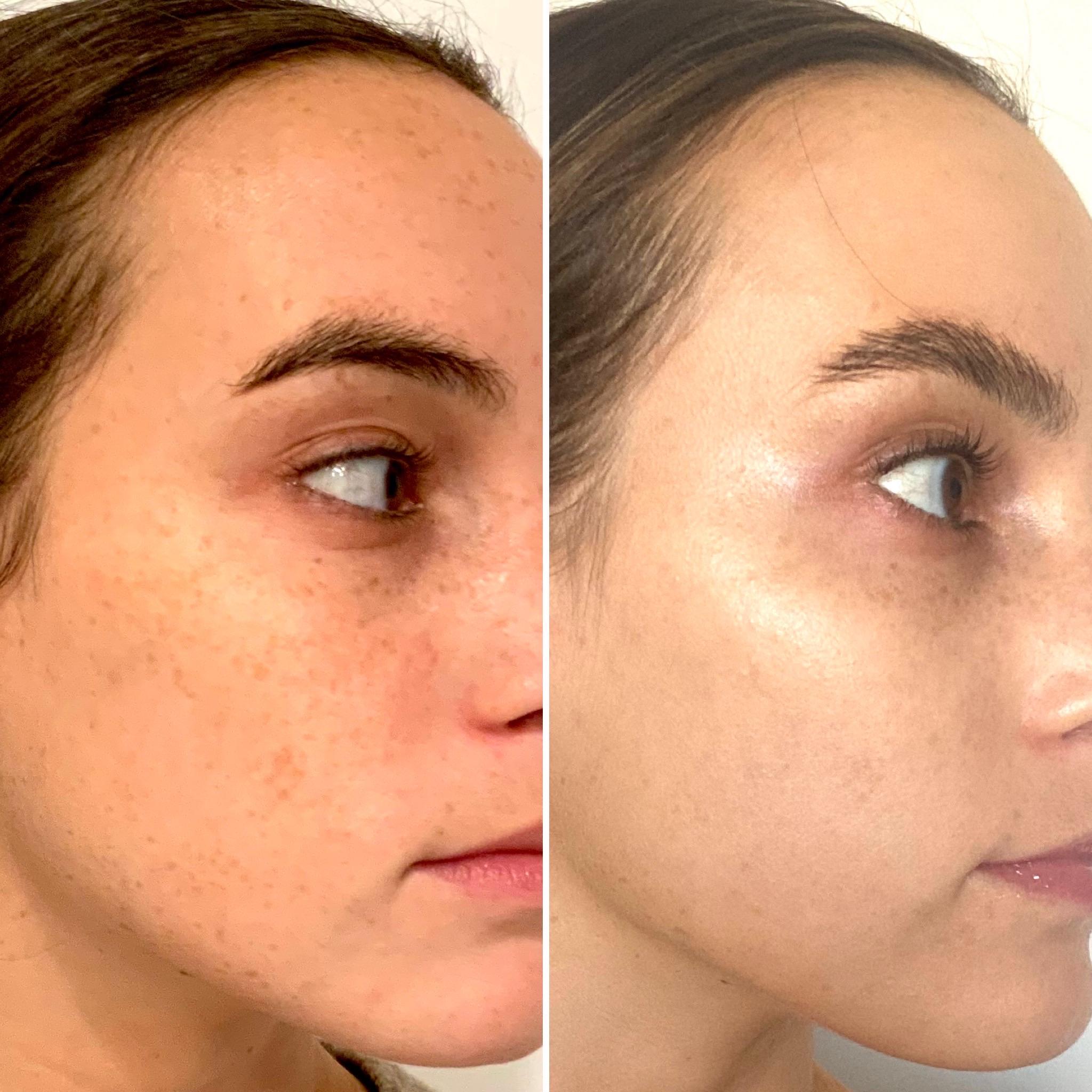 BBL HERO (Broad Band Light Therapy) - Skinlab Injectables